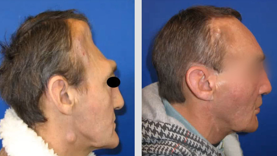 Cranioplastie. Pourquoi est-elle nécessaire